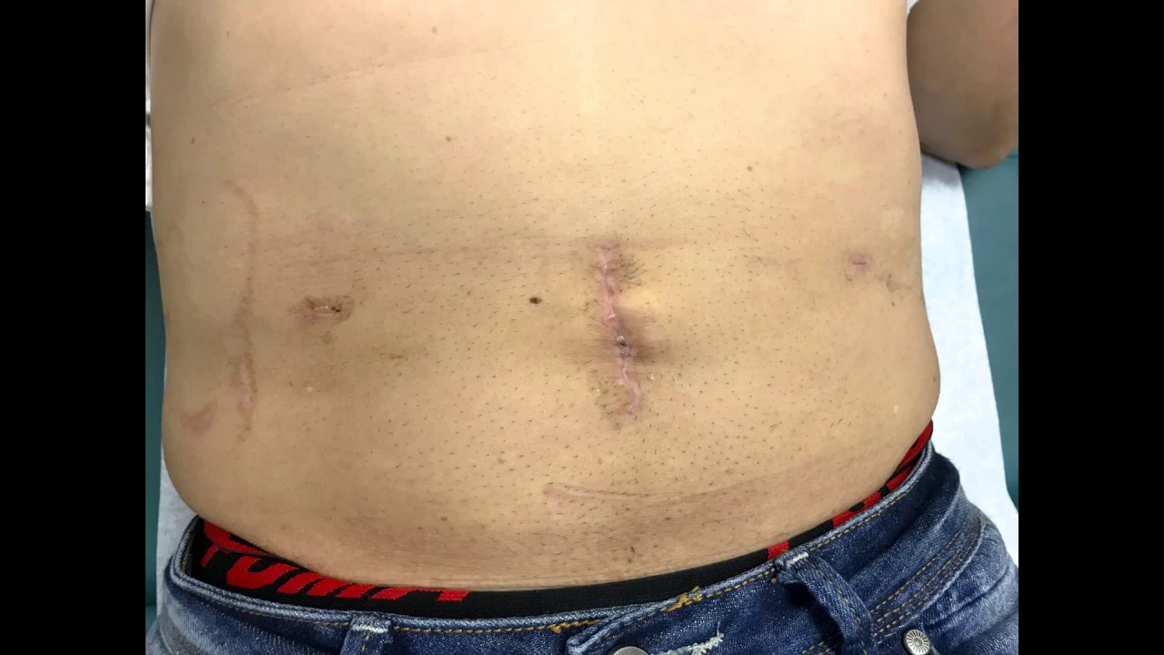 Robotic Partial Cystectomy For Large Complex Urachal Cyst Youtube