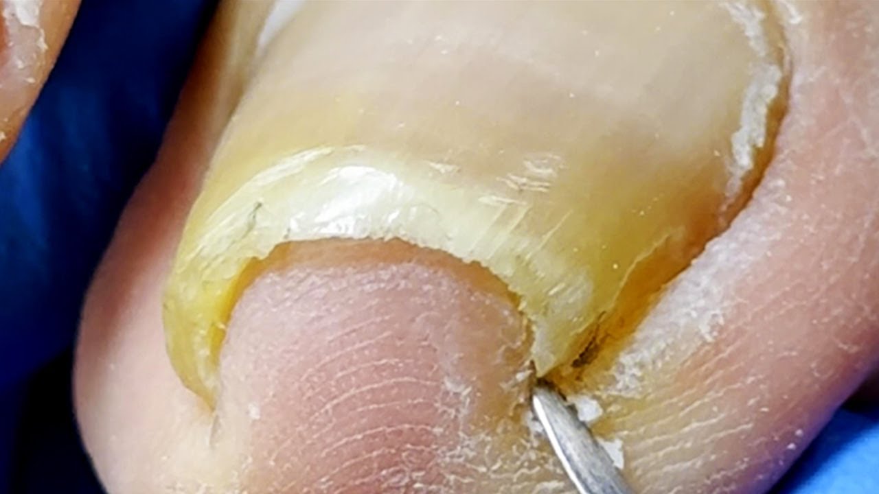 Extremely Curly Ingrown Toenails, Causing Torment To The Toes【Xue Yidao ...