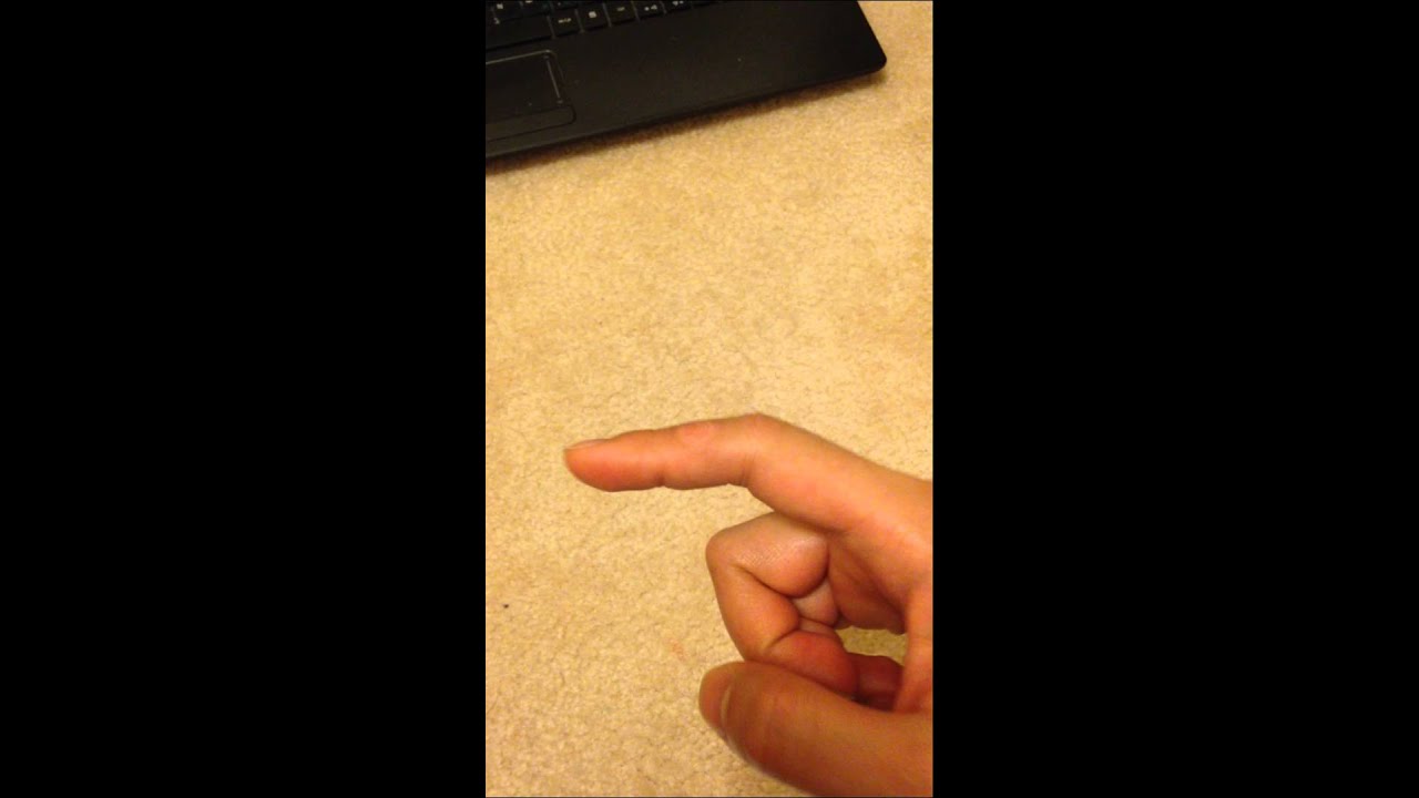 Wart on finger 30 days after freezing - YouTube