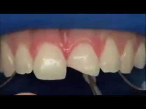 Dental restoration -class IV - YouTube