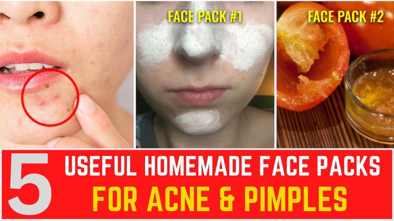 Get Rid of Acne and Pimples in 7 Days - TOP 5 Homemade Face Packs You ...