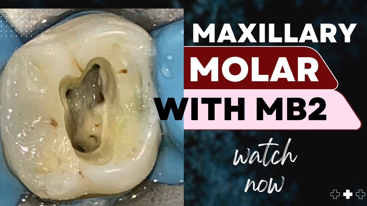 Maxillary Molar with MB2 - YouTube