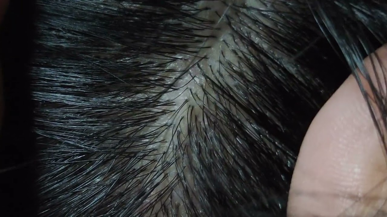 Relaxing and satisfying dandruff removal | visual ASMR to relax your ...