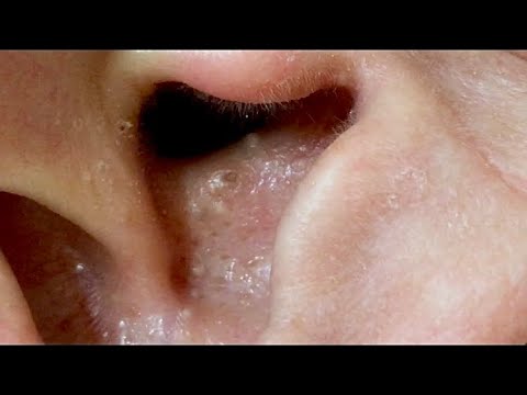 Milia inside the ear. - YouTube