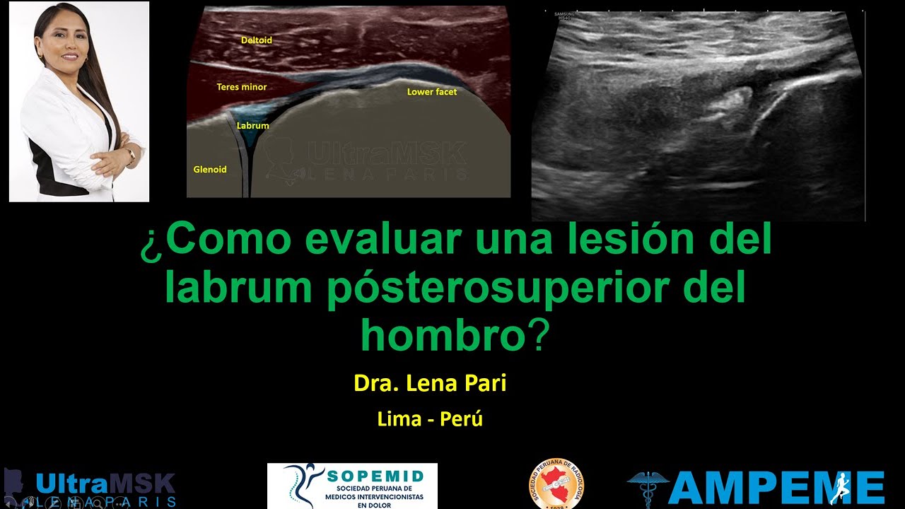 ¿Como evaluar el labrum pósterosuperior del hombro en ultrasonido ...