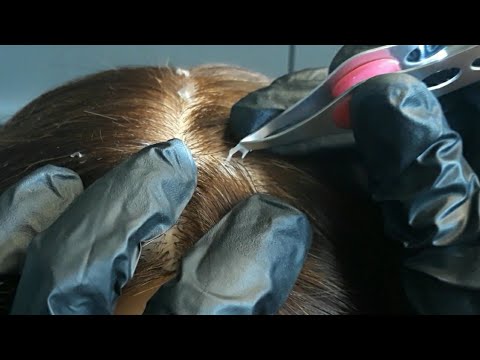 ASMR Scalp Treatment | Removing Flakes of Skin with Tweezers | No ...