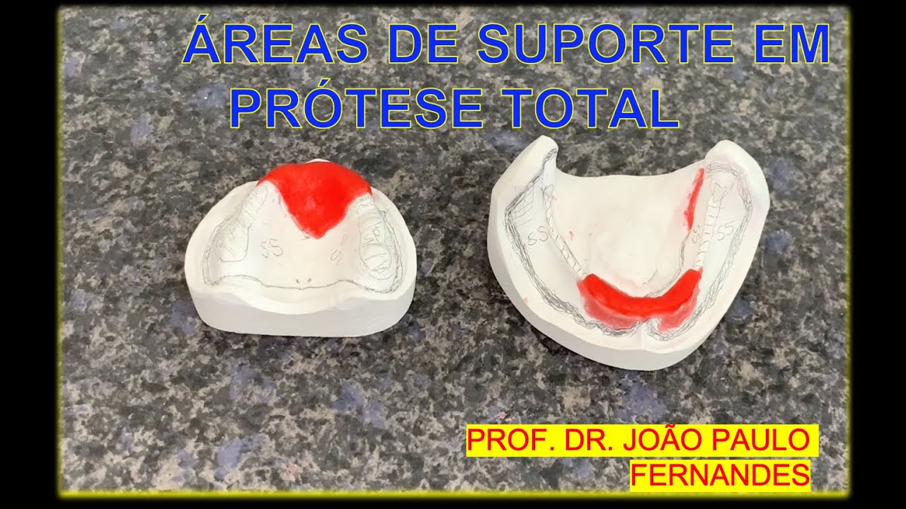5 Áreas de suporte em Prótese Total - YouTube