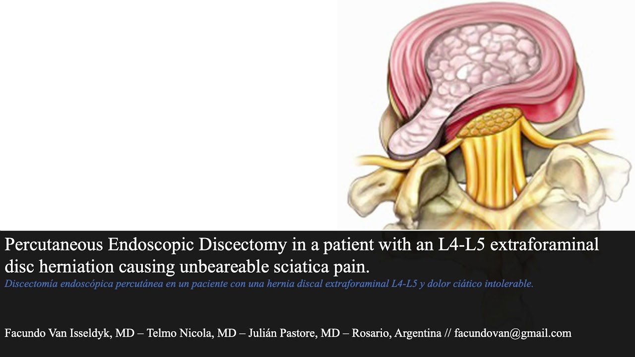 Extraforaminal disc herniation treated with endoscopic discectomy - YouTube
