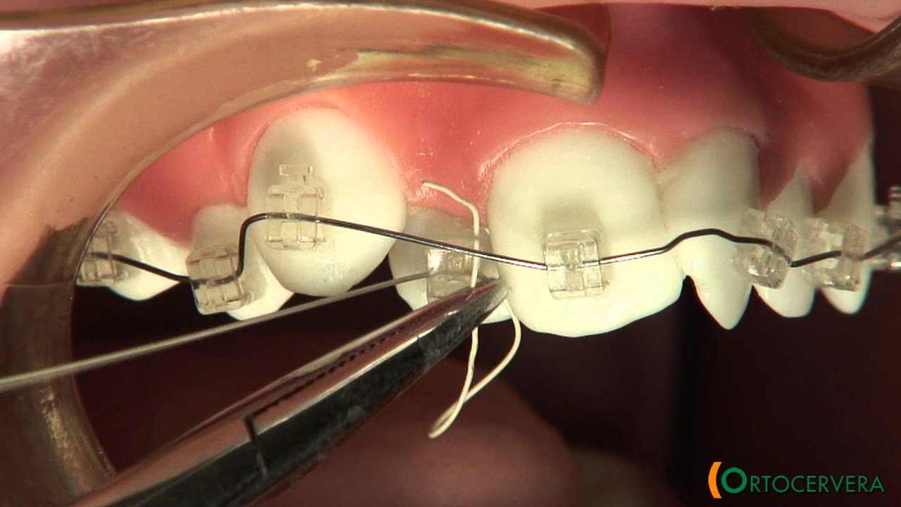 ORTOCERVERA / Ortodoncia: Ligadura Atípica - Brackets Autoligado ...
