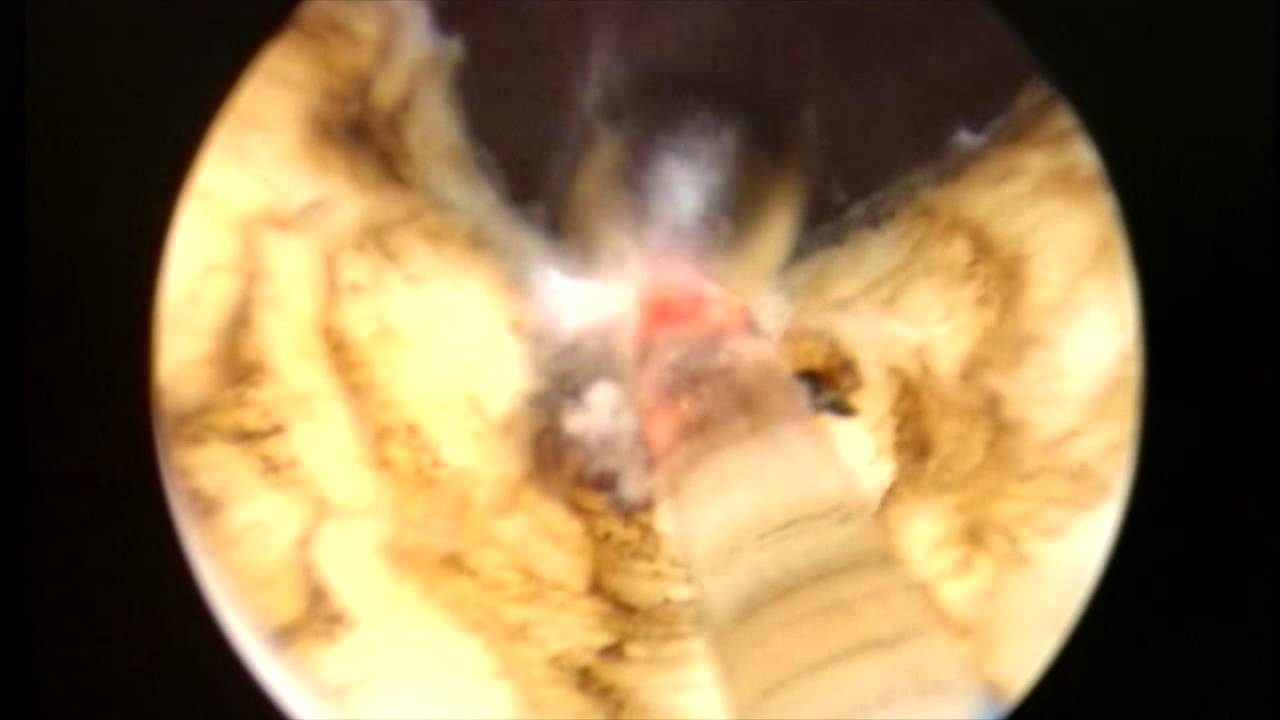 Incision cervico-prostatique laser Revolix Courlancy Reims - YouTube