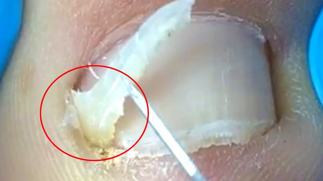 Cut out large ingrown nails easily! Toenail health【Crazy pedicure room ...