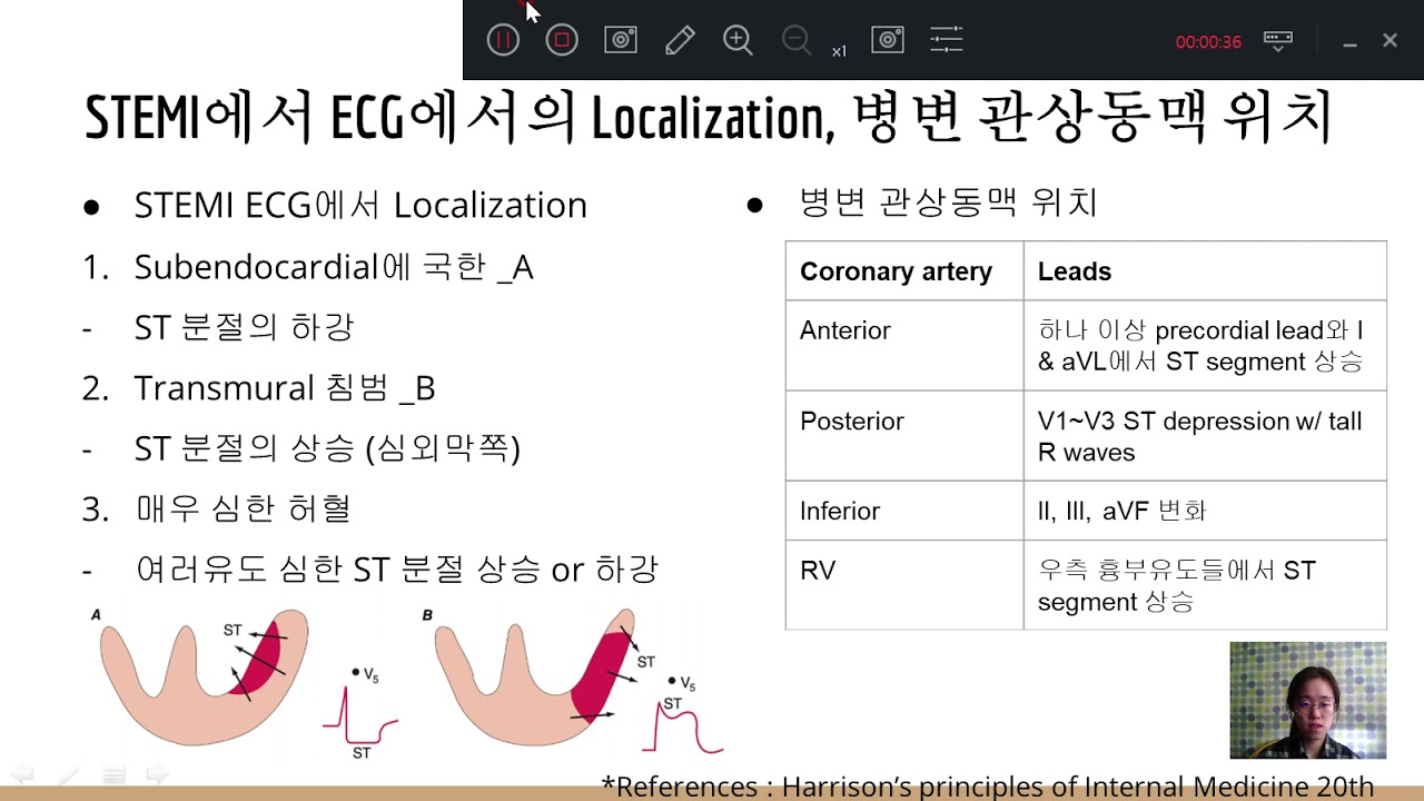 2019 9조 STEMI에서 ECG에서의 Localization 병변 관상동맥 위치 by 황해인 - YouTube