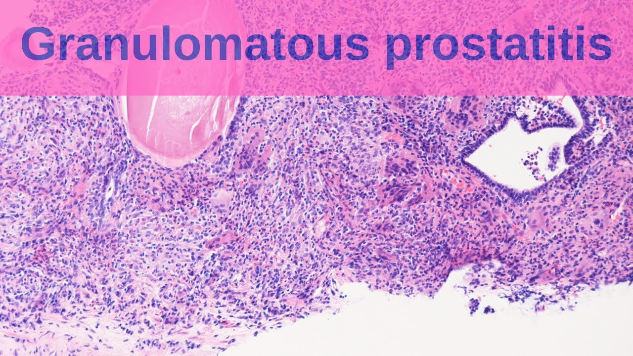 Granulomatous Prostatitis - Pathology mini tutorial - YouTube