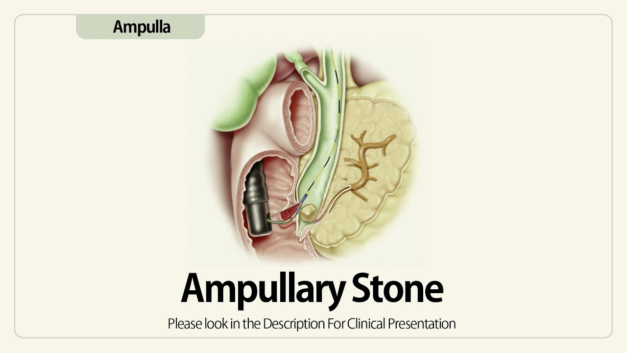 Linear EUS: Ampullary Stone - YouTube