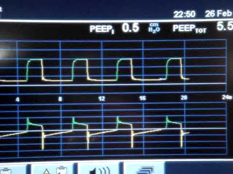 Obtaining a Intrinsic PEEP (PEEPi) measurement with the PB840 ...