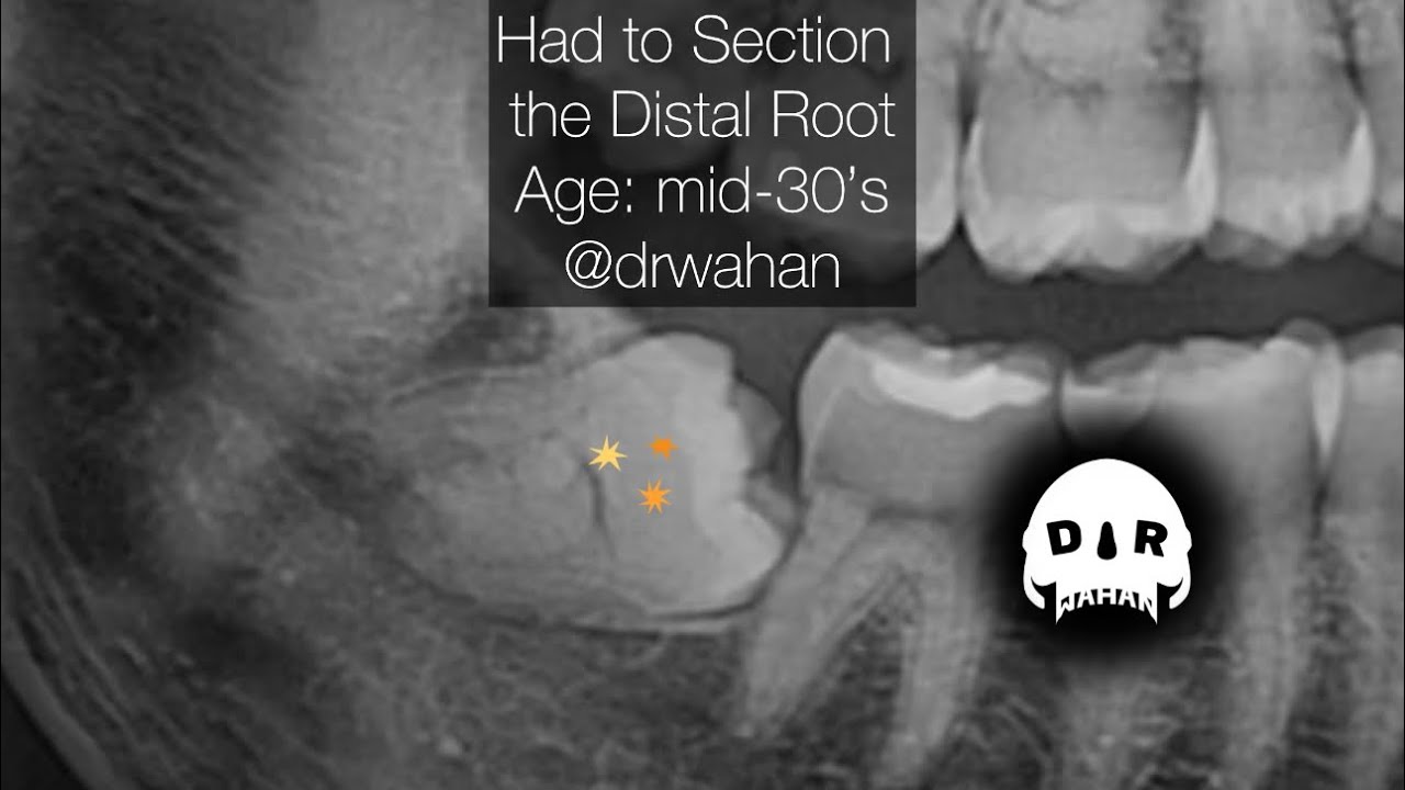 When you have to section a root to remove it: Wisdom Tooth Extraction ...