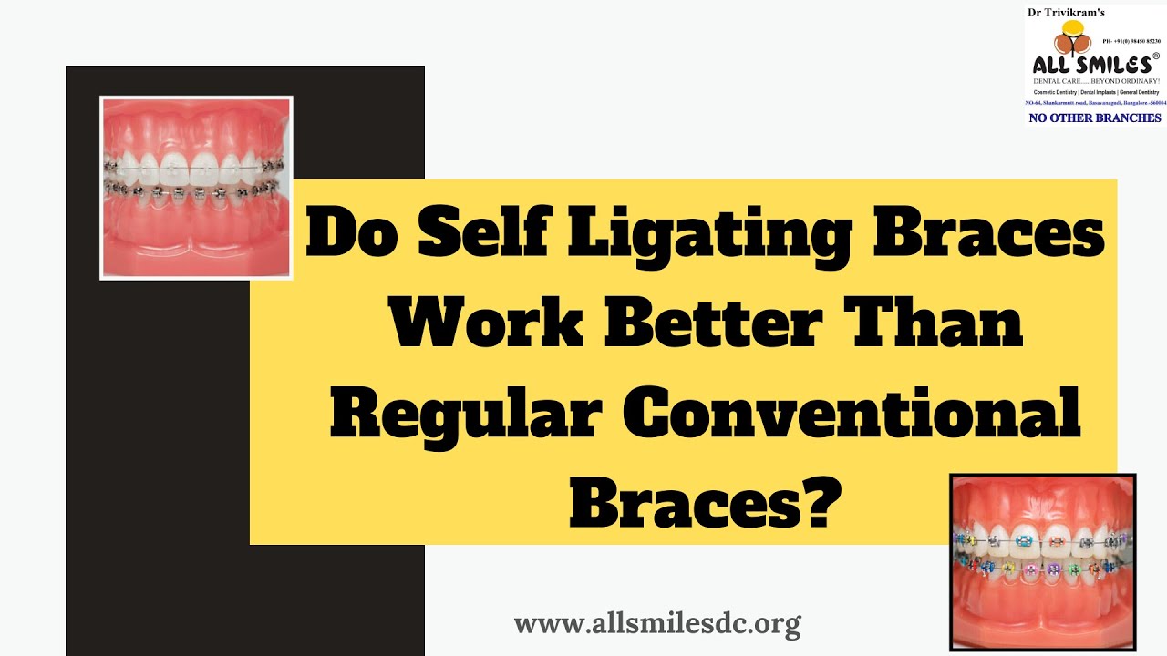 Do Self-Ligating Braces Works Better Than Regular Conventional Braces?| Best Dental Braces ...