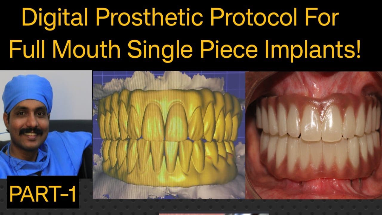 Digital workflow for full mouth prosthesis with single piece dental ...