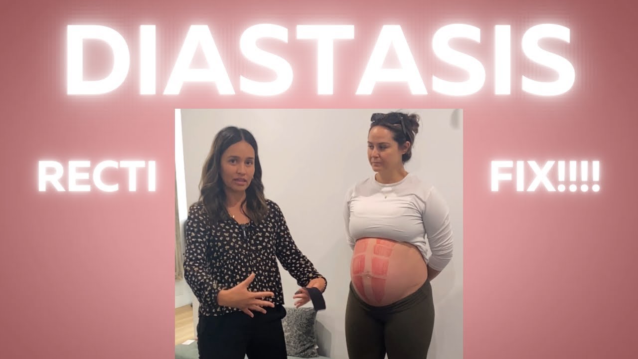 Diastasis Recti | Pregnancy Taping Therapy | Redondo Beach Chiropractor ...