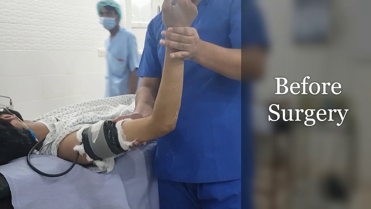 Stiff Elbow Joint: Reasons & Treatment - YouTube