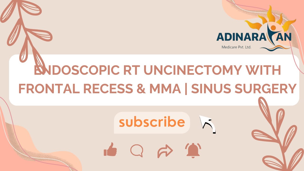 Endoscopic RT Uncinectomy with Frontal Recess & MMA | Sinus Surgery ...