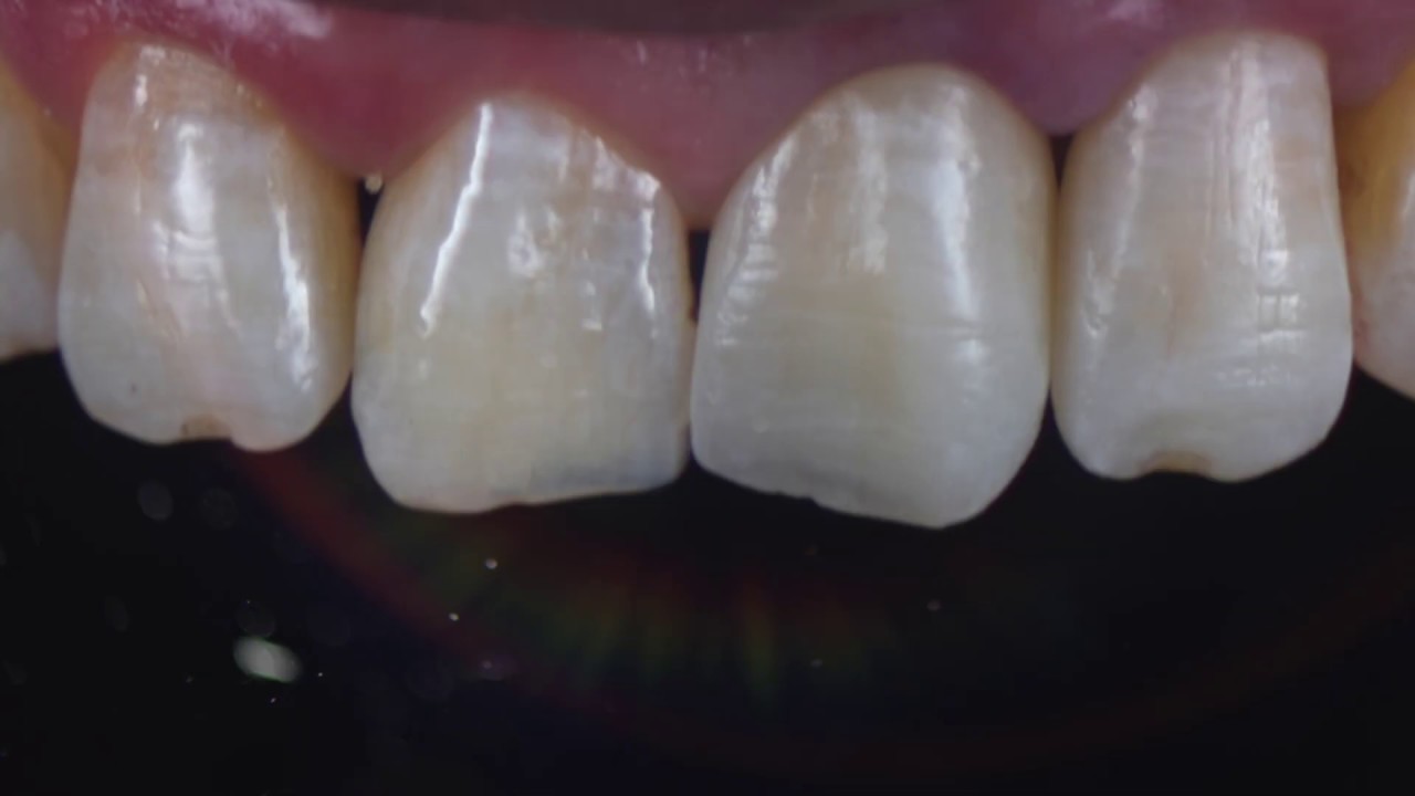 Full zirconia production using multi-layered block - YouTube