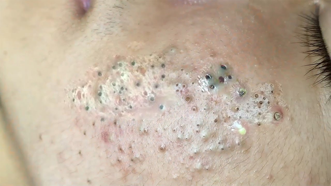 Big Cystic Acne Blackheads Extraction Blackheads & Milia, Whiteheads ...