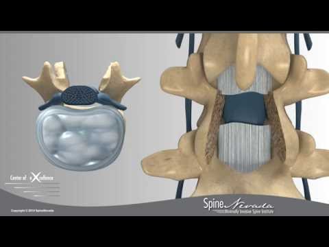 Lumbar Laminectomy and Fusion Presented by Swift Institute, Reno Spine Surgeons and Spine Center