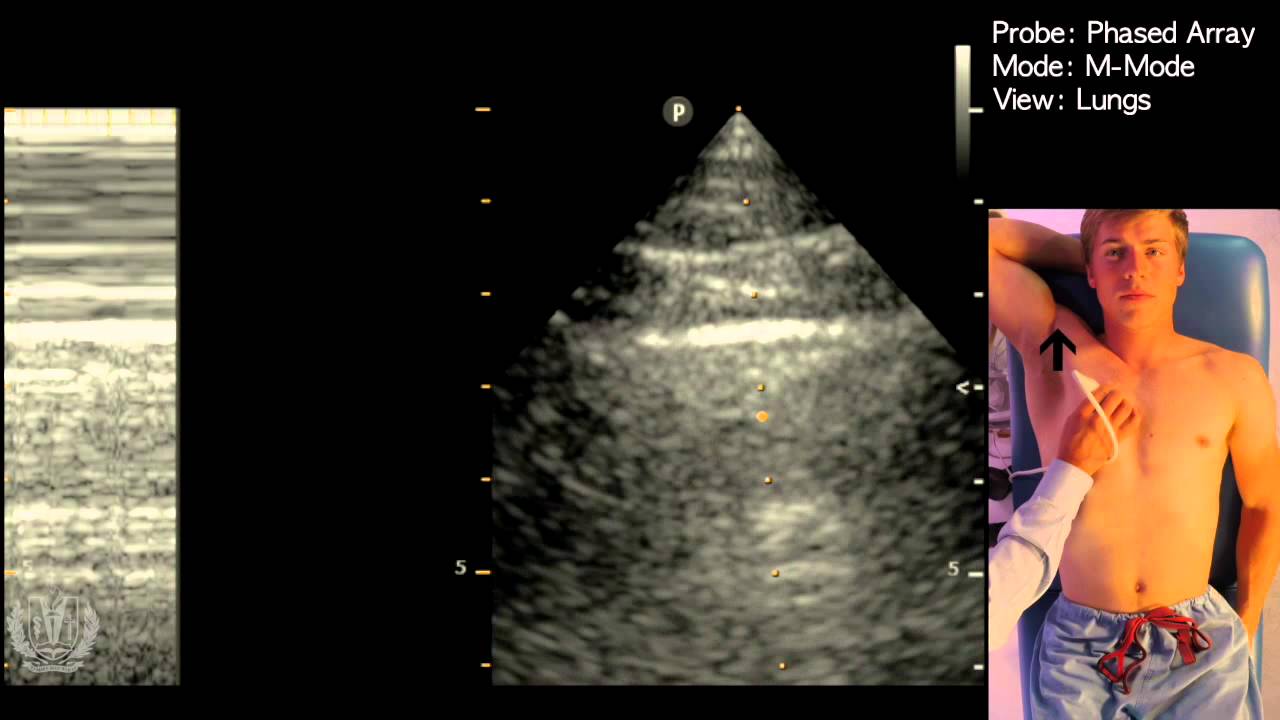 M Mode Ultrasound