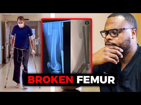 How Long Does It Take To Recover From Femur Rod