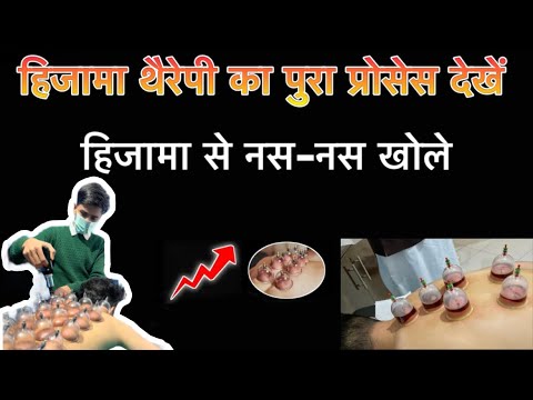 Hijama Therepy process | How is Hijama therapy done? #cupping #hijama # ...
