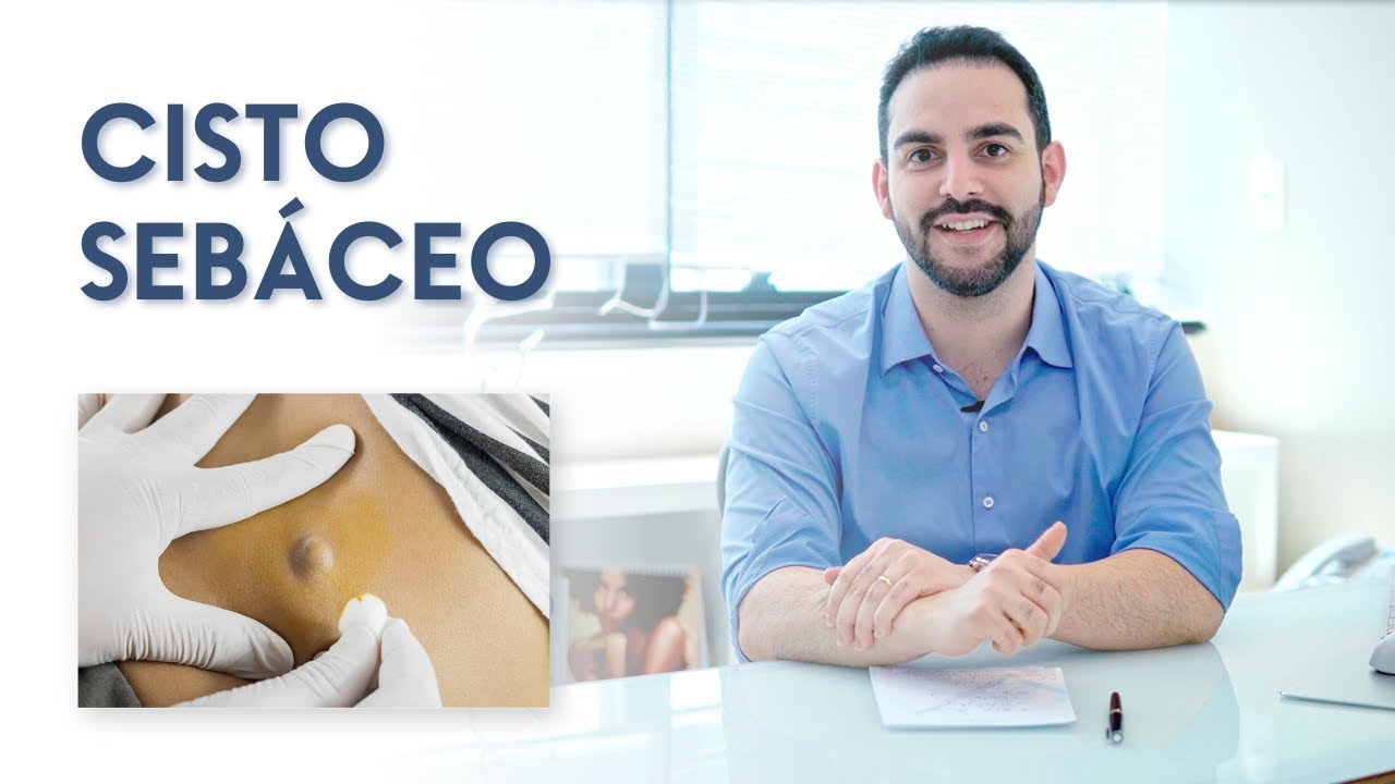Cisto Sebáceo: saiba como resolver - YouTube