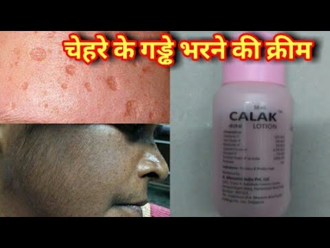 चेहरे के गड्ढे भरने की क्रीम | Best cream for skin problems | calak ...