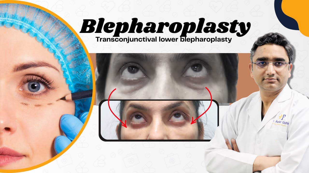 Lower Eyelid Blepharoplasty with Fat Repositioning | Blepharoplasty ...