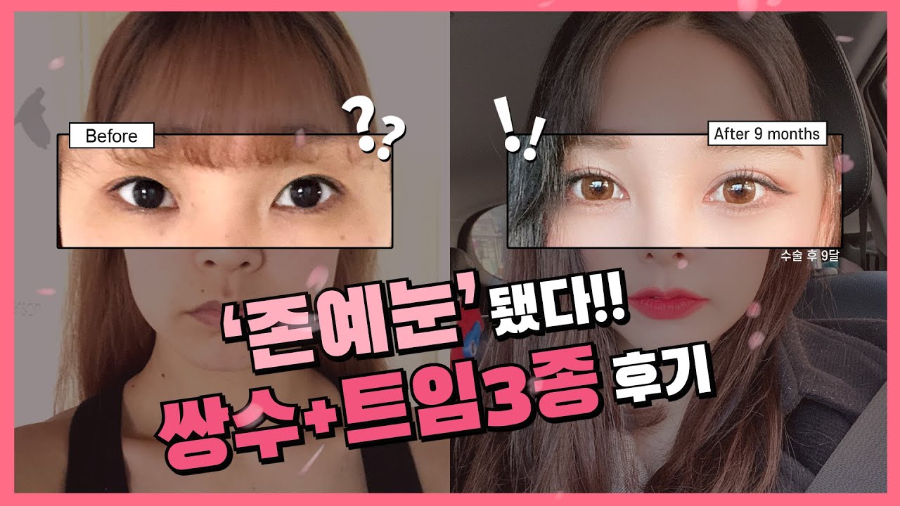 쌍수브이로그 눈매교정쌍수트임성형앞트임 뒤트임 밑트임 후기 트임전후 쌍꺼풀수술 쌍커플수술 쌍꺼플수술 쌍커풀수술 눈성형브이로그 별성형