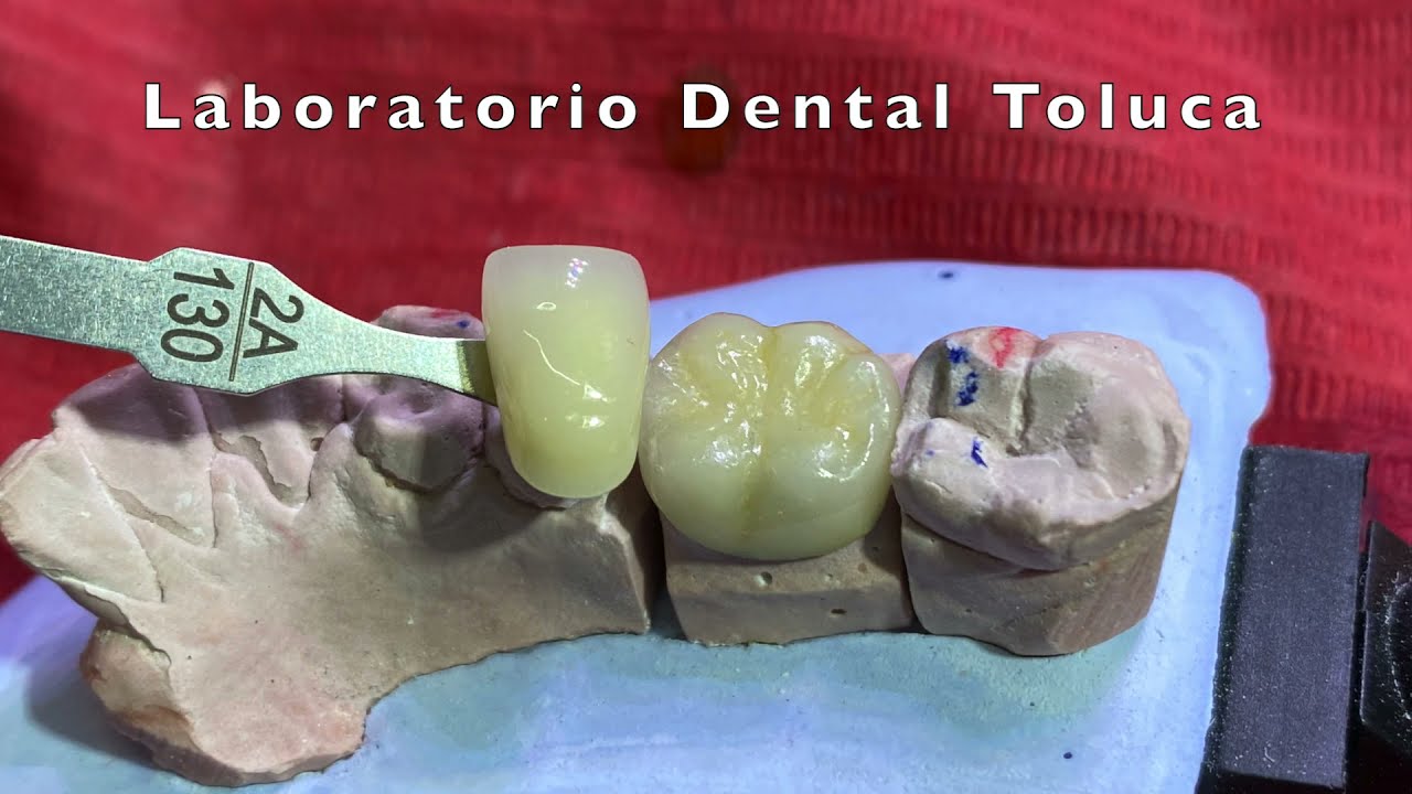 ELABORACION DE CORONA METAL PORCELANA PASO A PASO - YouTube