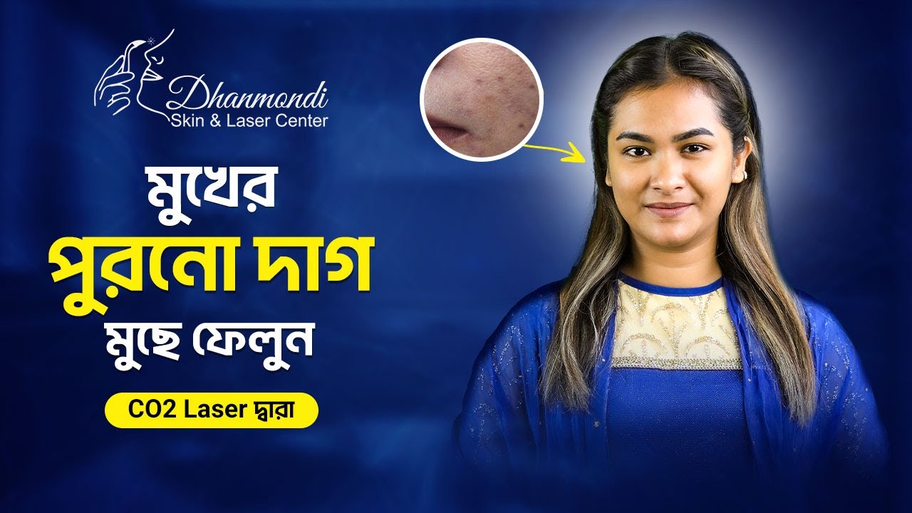 মুখের কালো দাগ দূর করার উপায় । Acne Spot Laser Treatment । mukher kalo ...