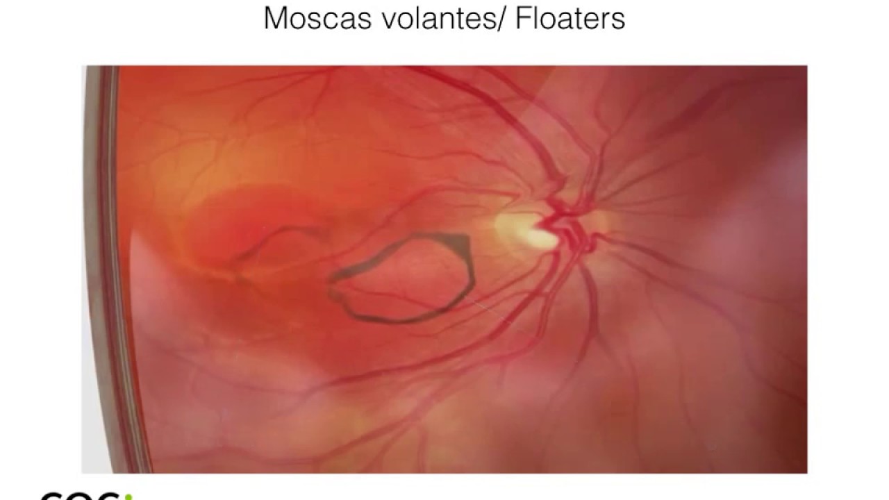 moscas flotantes/volantes - YouTube