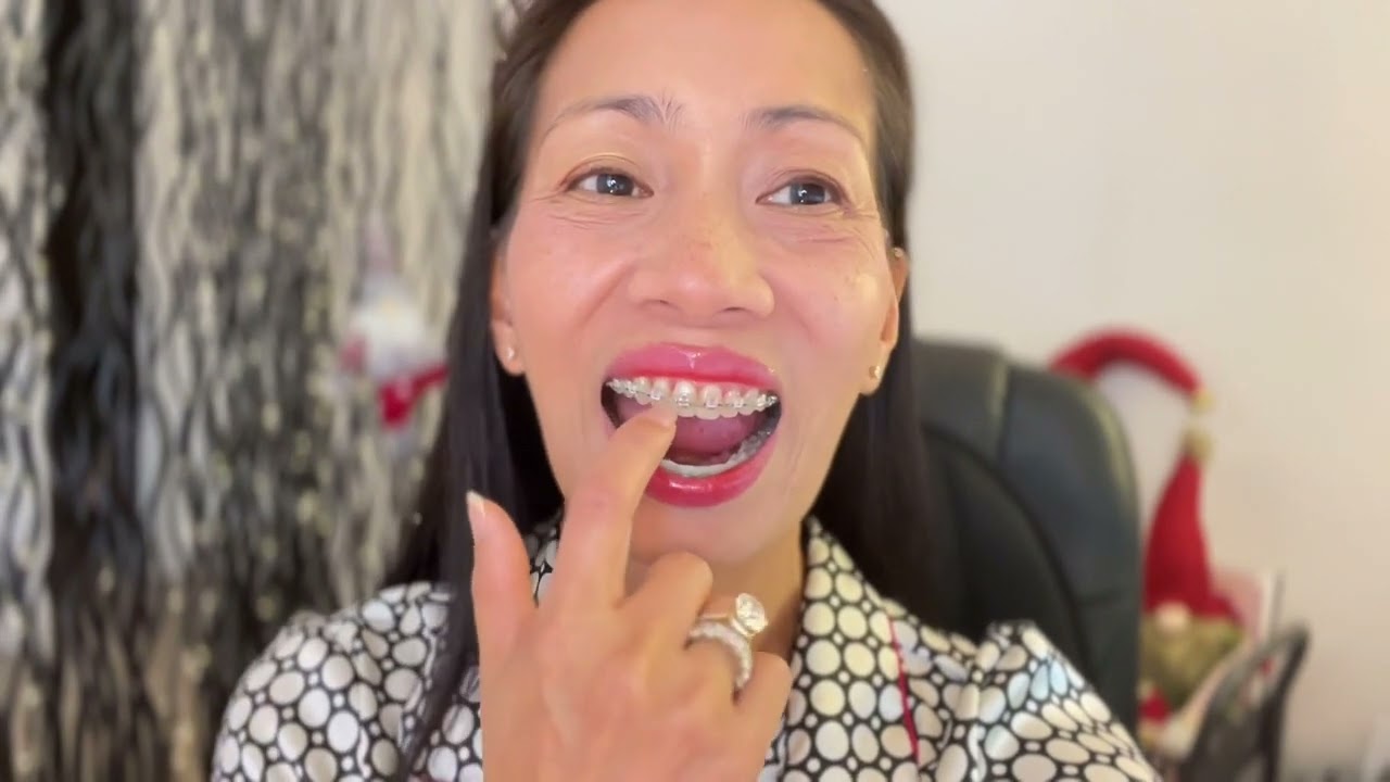 BRACES JOURNEY : Almost 3 years braces update. - YouTube
