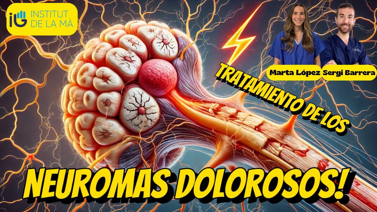 Tratamiento de los Neuromas Dolorosos - YouTube