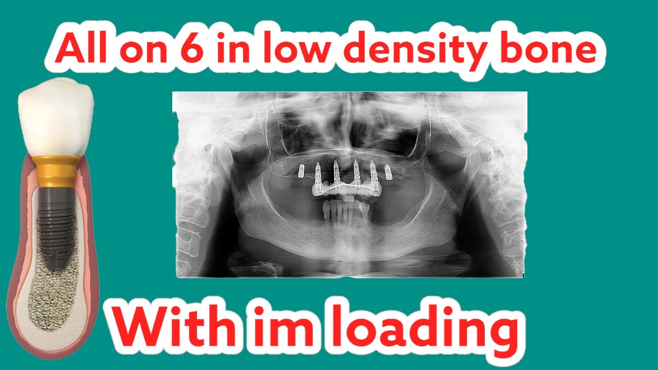 AO6 implant placement with immediate loading in D4 BONE - YouTube