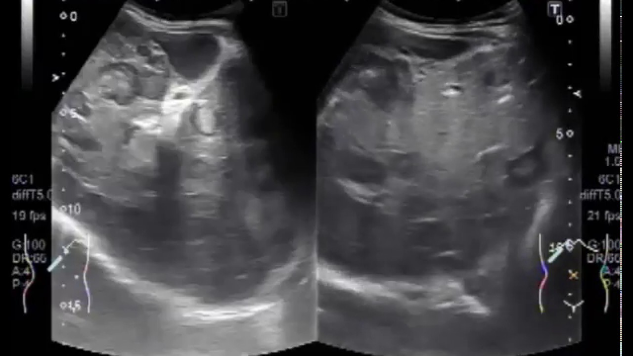Ultrasound Video showing Hepatic masses with multiple metastasis. - YouTube