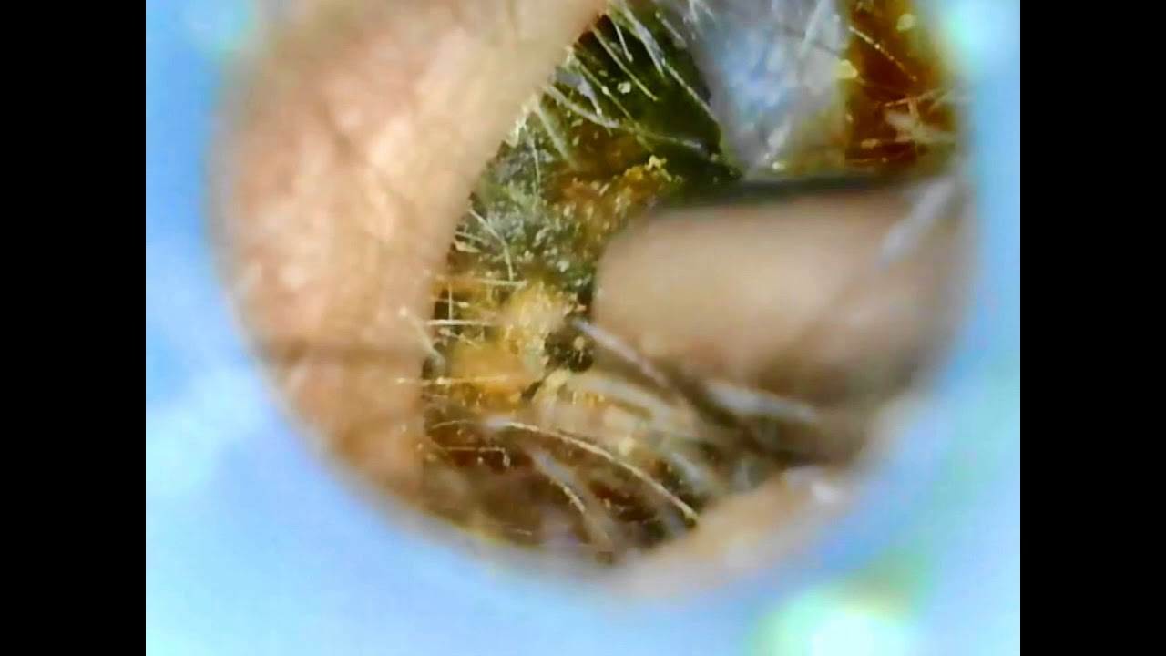 Satisfying Ear Wax Removal Compilation #1 - YouTube