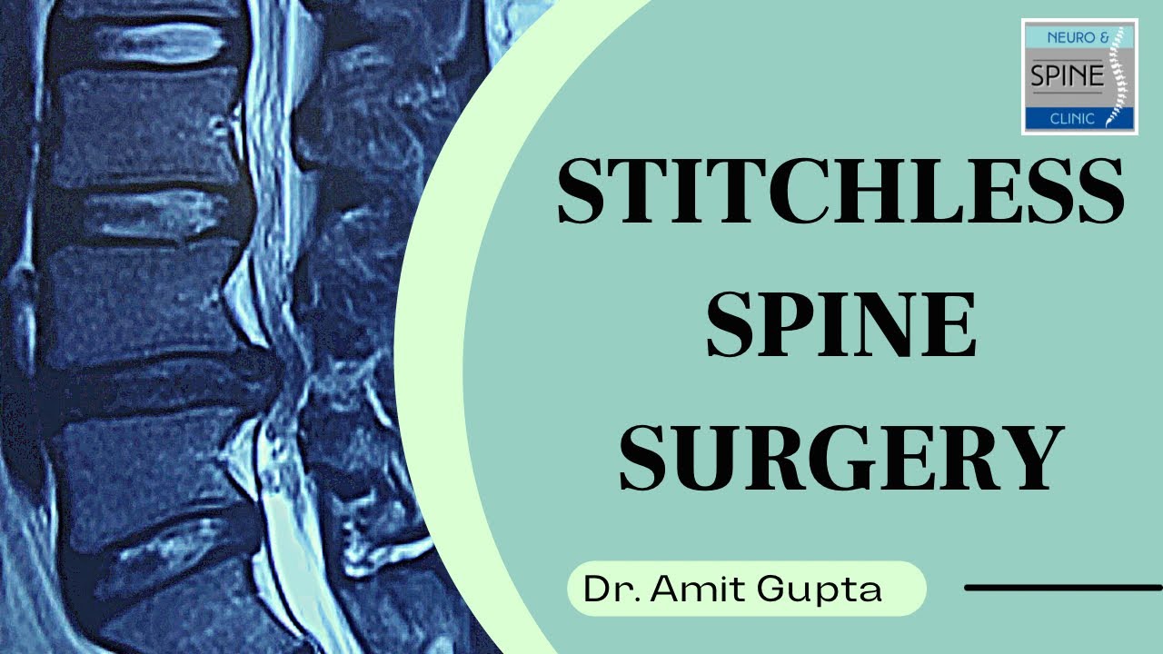Stitchless spine surgery for Sciatica and Disc prolapse - YouTube