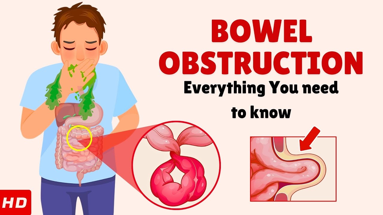 Bowel Obstruction – Causes, Signs and Symptoms, Diagnosis & Treatment ...