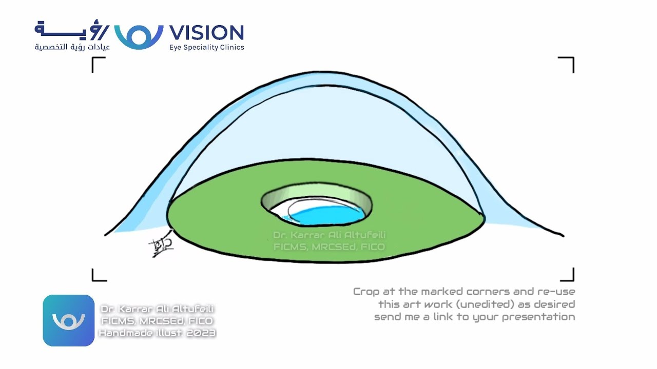 Lasso scleral fixation technique for subluxated IOL #Ophthalmology ...