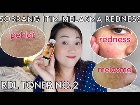 BAKIT NANGINGITIM ANG MUKHA KO SA RDL TONER NUMBER 2? ANONG GAGAWIN ...