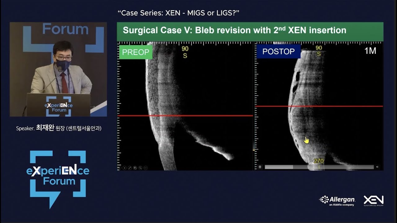 [XEN 녹내장 스텐트 수술] Case Series: XEN - MIGS, or LIGS? - YouTube