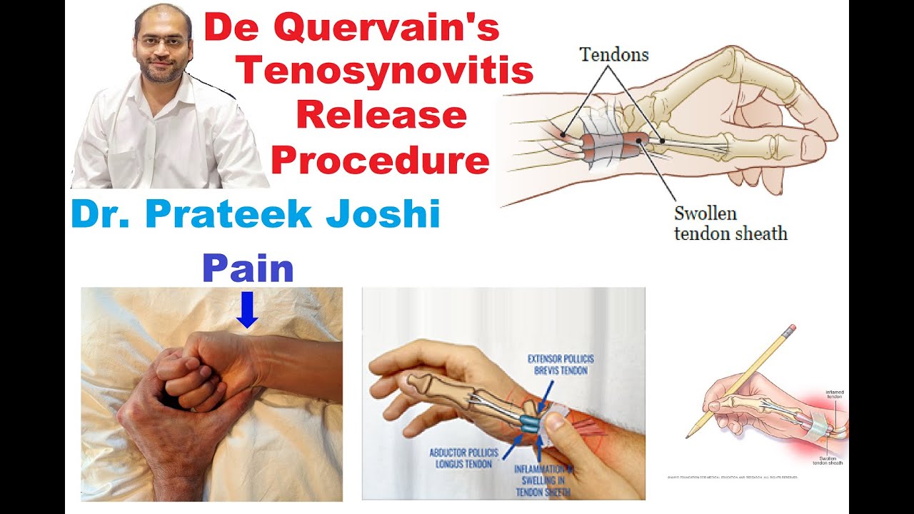 De Quervain's Tenosynovitis Release Surgery | Dr. Prateek Joshi - YouTube