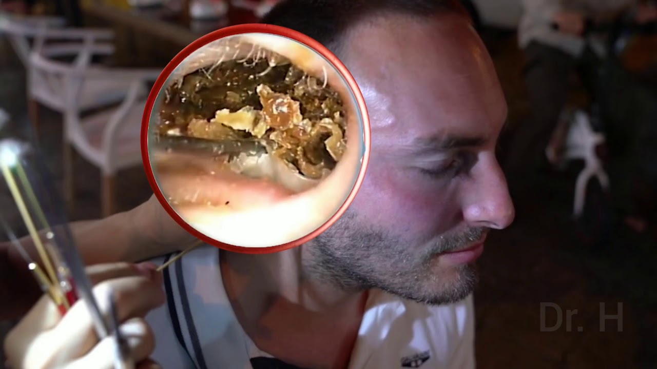 Ráy tai kinh dị•Horror ear wax| Dr. H• HD - YouTube